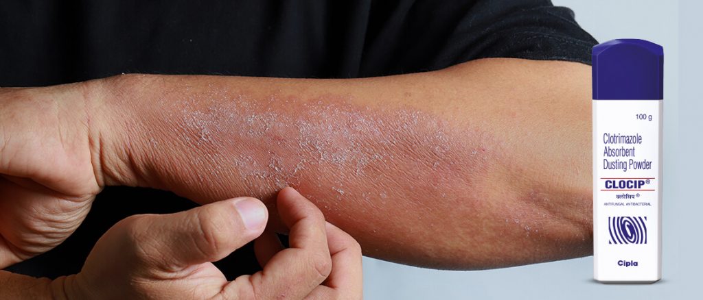 Role of Antifungal Powder in Treating Skin Infection | Clocip