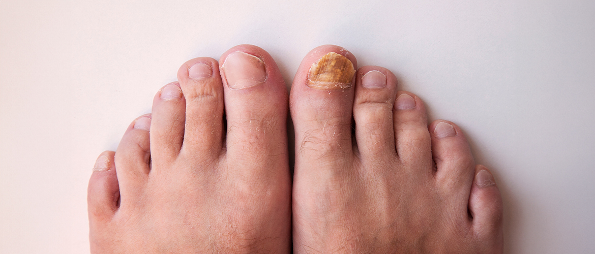 Understanding Fungal Nail Infections: Causes and Treatment Options ...