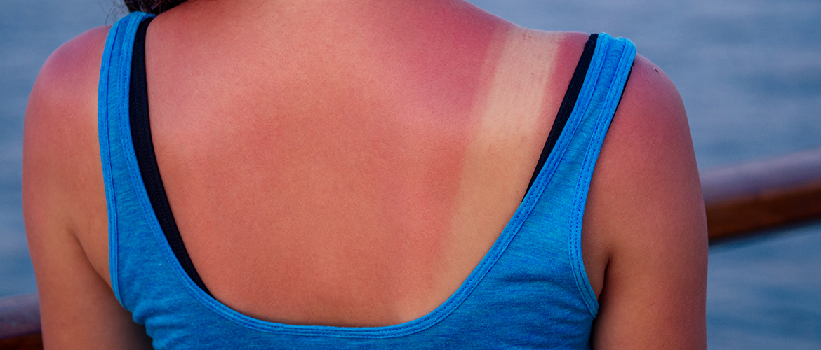Sunburn Prevention And Care Essential Tips For Healthy Skin Clocip Blog