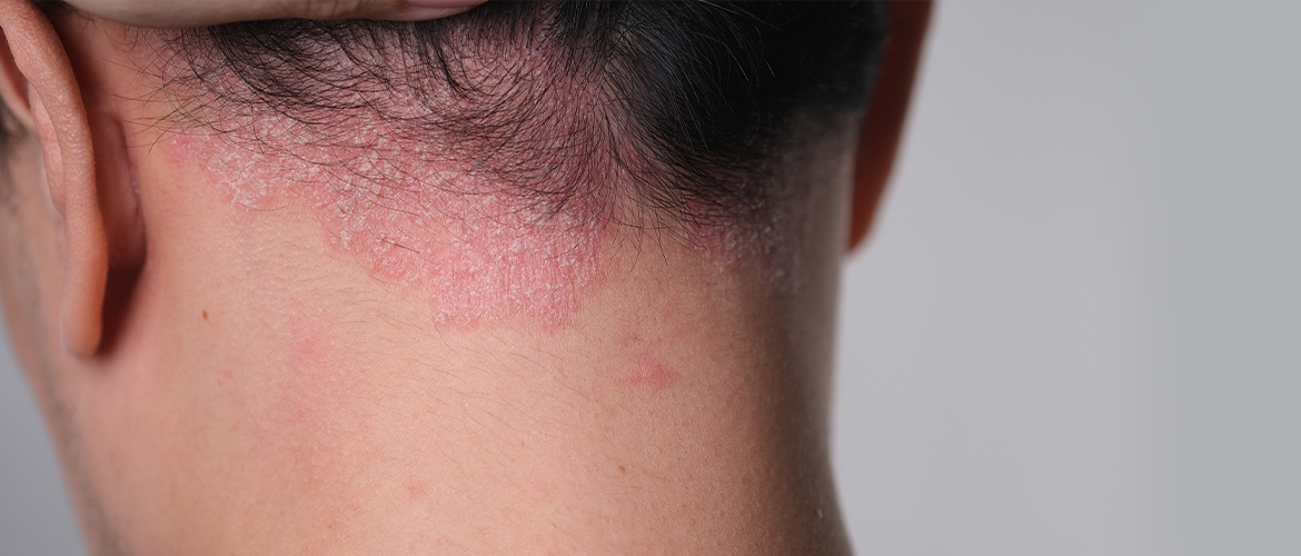 How Can Scalp Fungal Infections Trigger Hair Loss? | CLOCIP - Cipla